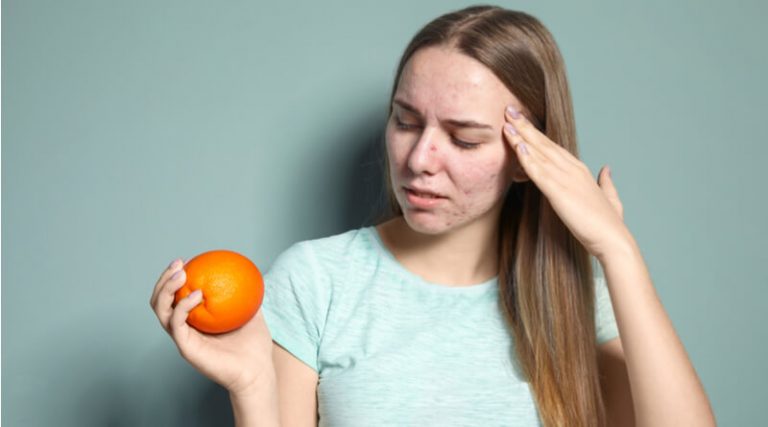 What Can You Eat When You Have a Fruit Allergy? – Vaya News